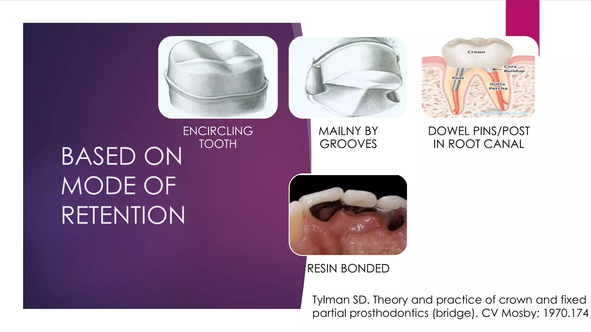 Retainers in FPD (FIXED PARTIAL DENTURES) PDF copy | PDF