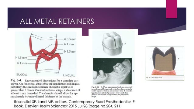 Retainers in FPD (FIXED PARTIAL DENTURES) PDF copy | PDF | Dental ...
