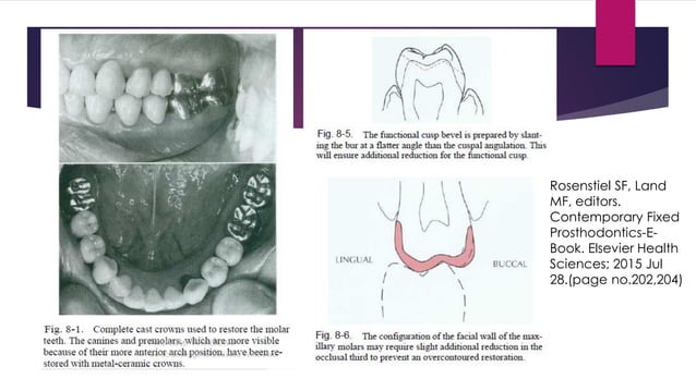 Retainers in FPD (FIXED PARTIAL DENTURES) PDF copy | PDF | Dental ...