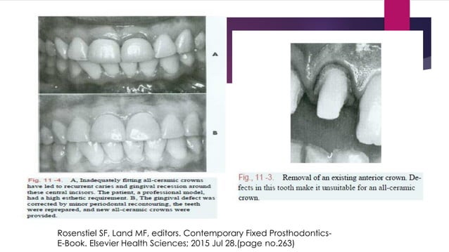 Retainers in FPD (FIXED PARTIAL DENTURES) PDF copy | PDF | Dental ...