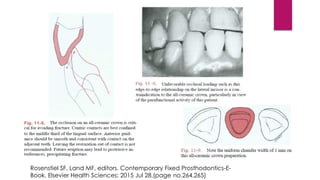 Retainers in FPD (FIXED PARTIAL DENTURES) PDF copy | PDF