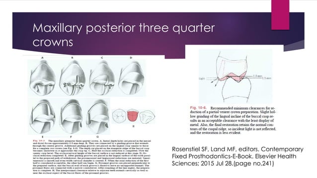 Retainers in FPD (FIXED PARTIAL DENTURES) PDF copy | PDF | Dental ...