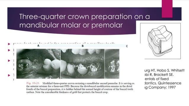 Retainers in FPD (FIXED PARTIAL DENTURES) PDF copy | PDF | Dental ...