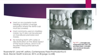 Retainers in FPD (FIXED PARTIAL DENTURES) PDF copy | PDF