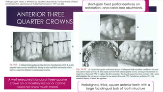 Retainers in FPD (FIXED PARTIAL DENTURES) PDF copy | PDF