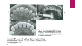 Retainers in FPD (FIXED PARTIAL DENTURES) PDF copy | PDF