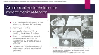 Retainers in FPD (FIXED PARTIAL DENTURES) PDF copy | PDF