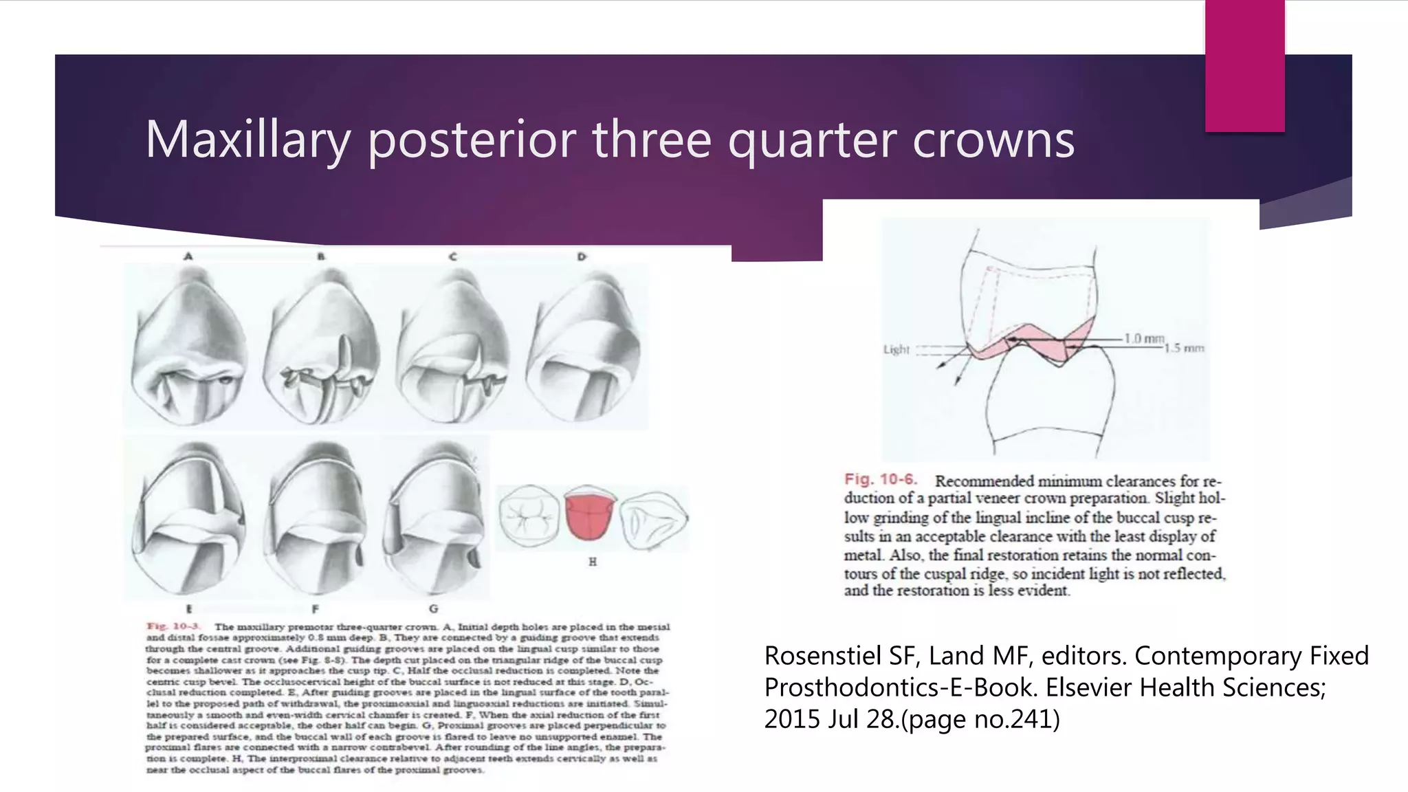 Retainers in FIXED PARTIAL DENTURES(FPDS) AND RESIN BONDED FPD | PPTX