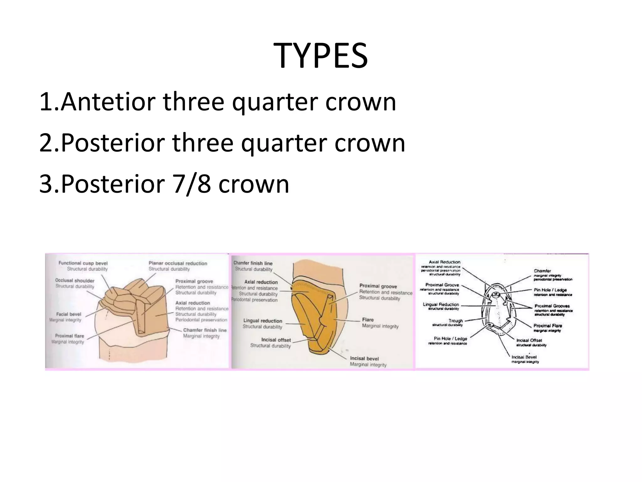 Retainers in fpd | PPT