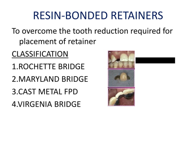 Retainers in fpd | PPT | Dental Health | Diseases and Conditions