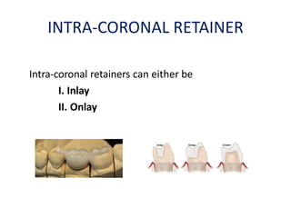 Retainers in fpd | PPT