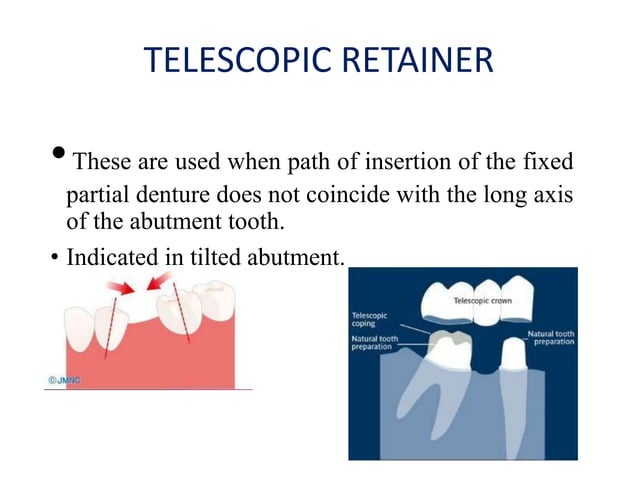 Retainers in fpd | PPT | Dental Health | Diseases and Conditions