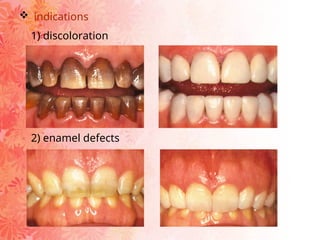 Direct and indirect retainers in fixed denture prosthodontics | PPT