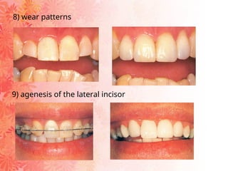 Direct and indirect retainers in fixed denture prosthodontics | PPT
