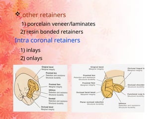 Direct and indirect retainers in fixed denture prosthodontics | PPT