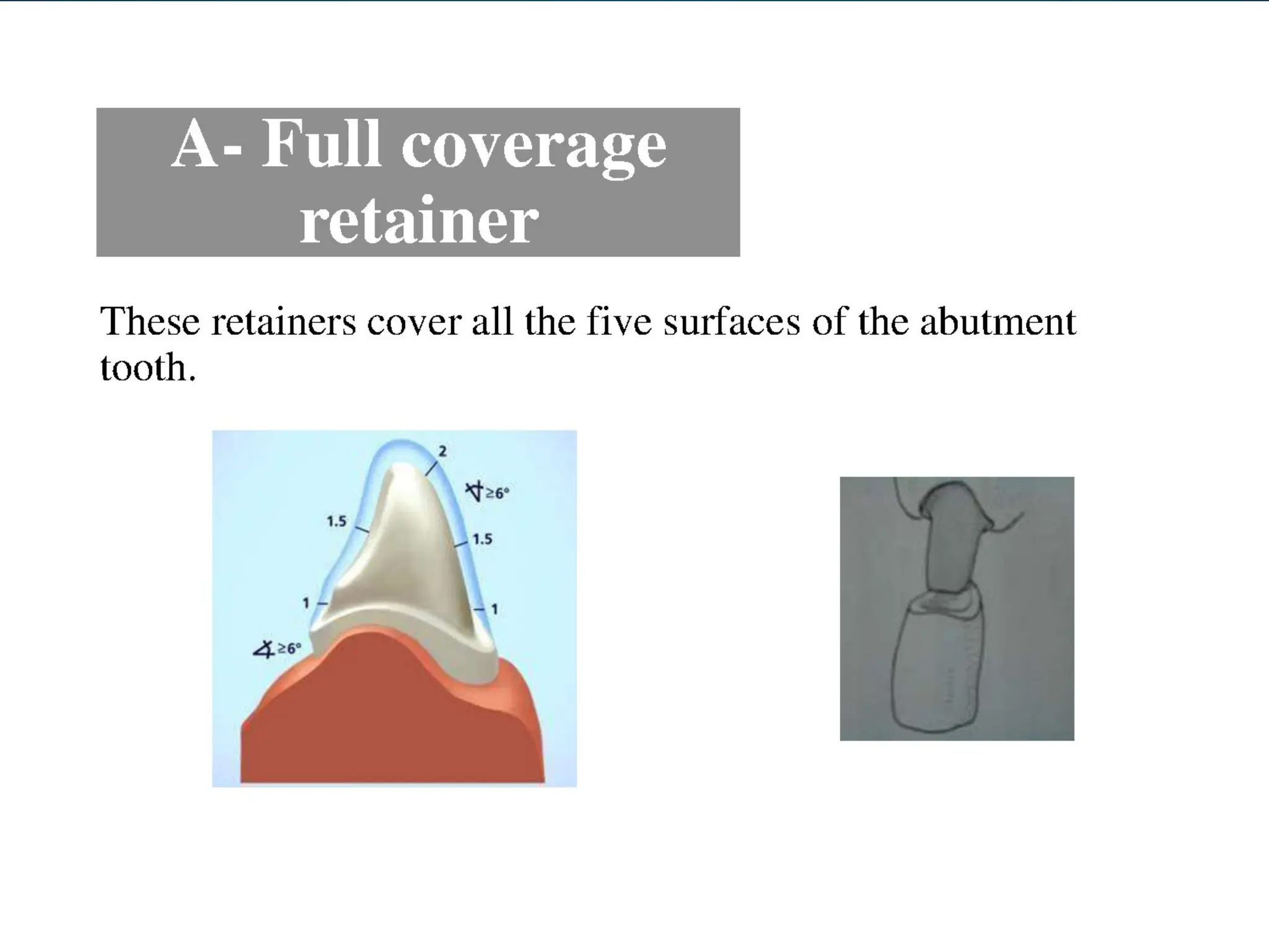 retainers in fixed partial denture...... | PPTX