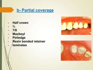 RETAINERS USED FOR FIXED PROSTHODONTICS.ppt