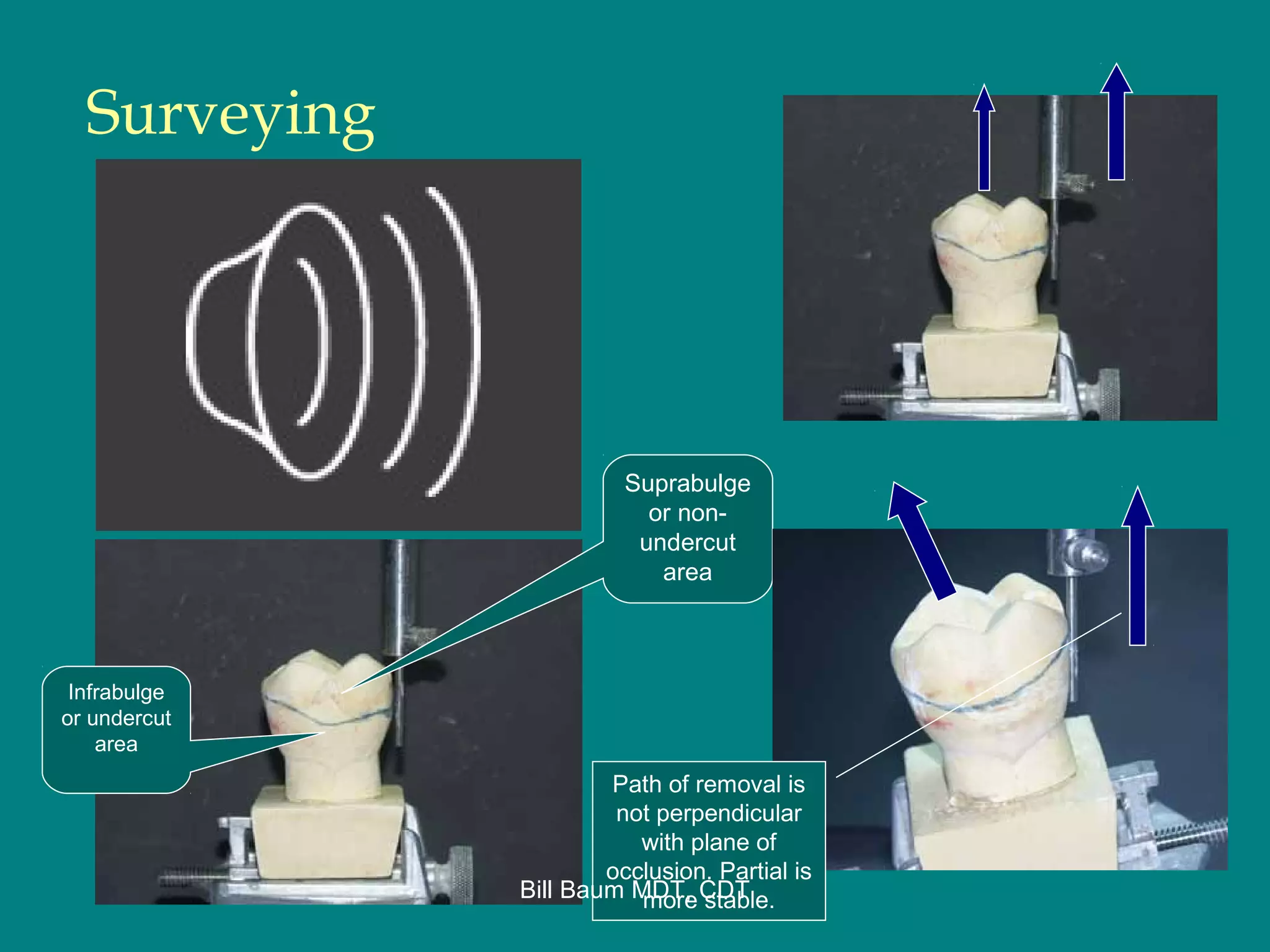 Removable Partial denture Retainer Systems | PPT