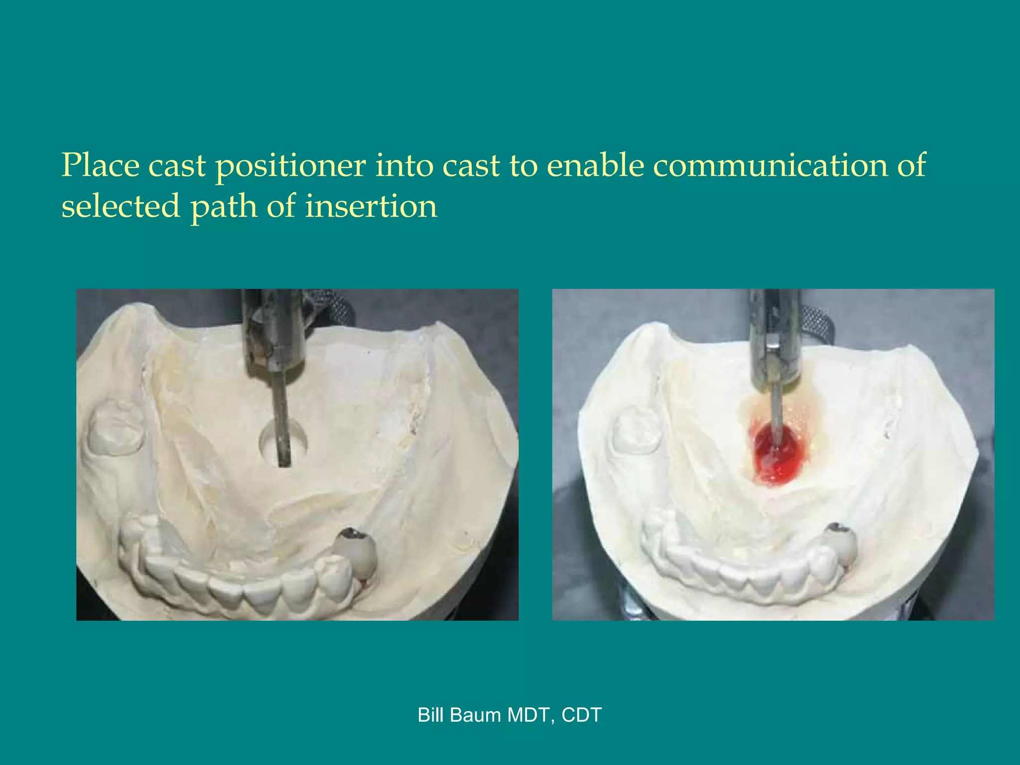 Removable Partial denture Retainer Systems | PPT