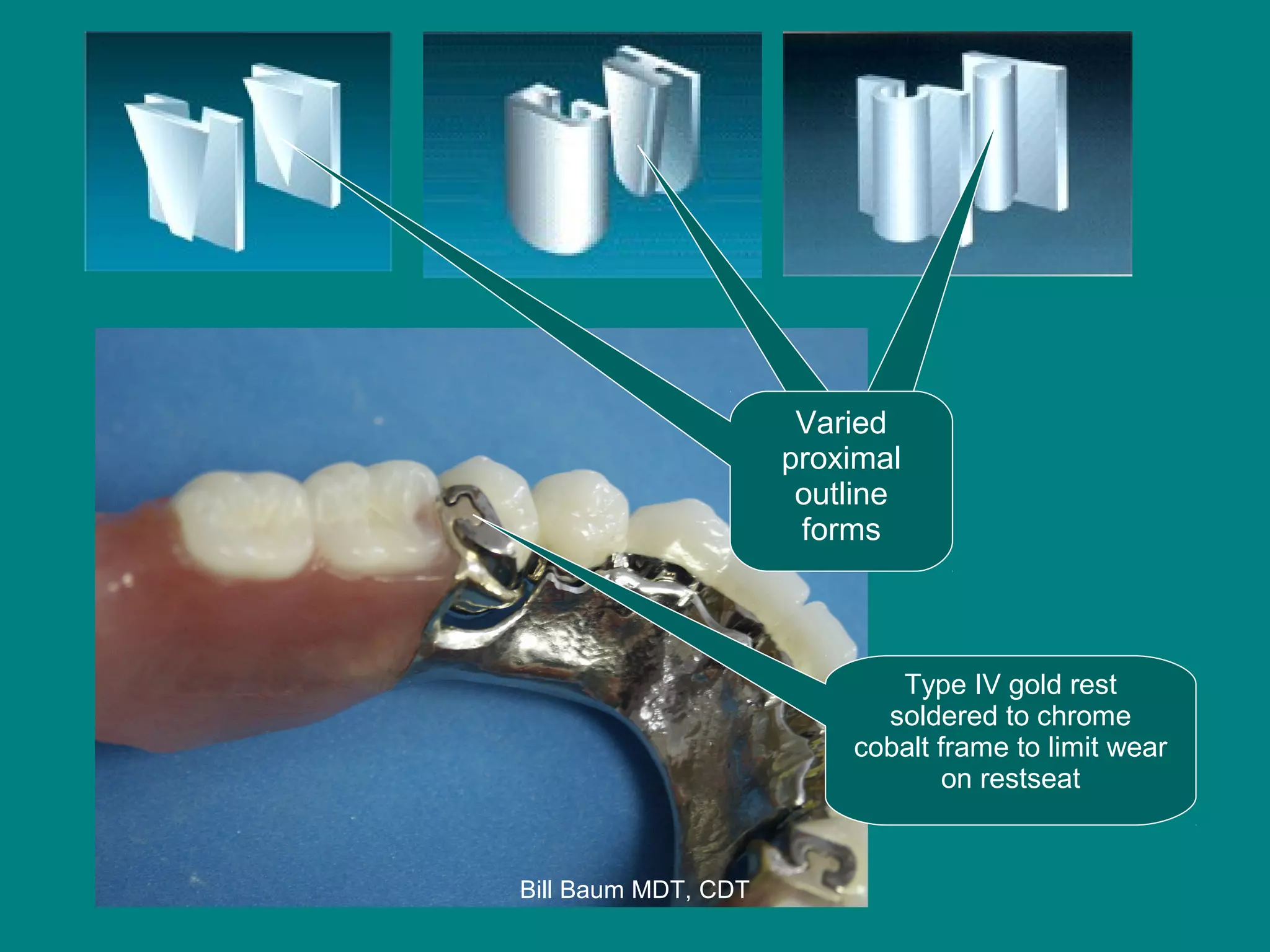 Removable Partial denture Retainer Systems | PPT