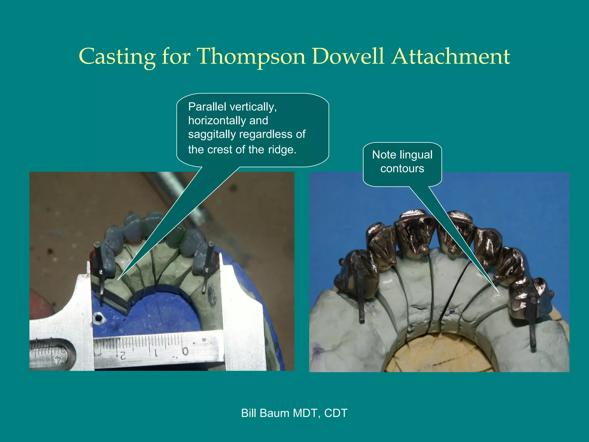 Removable Partial denture Retainer Systems | PPT