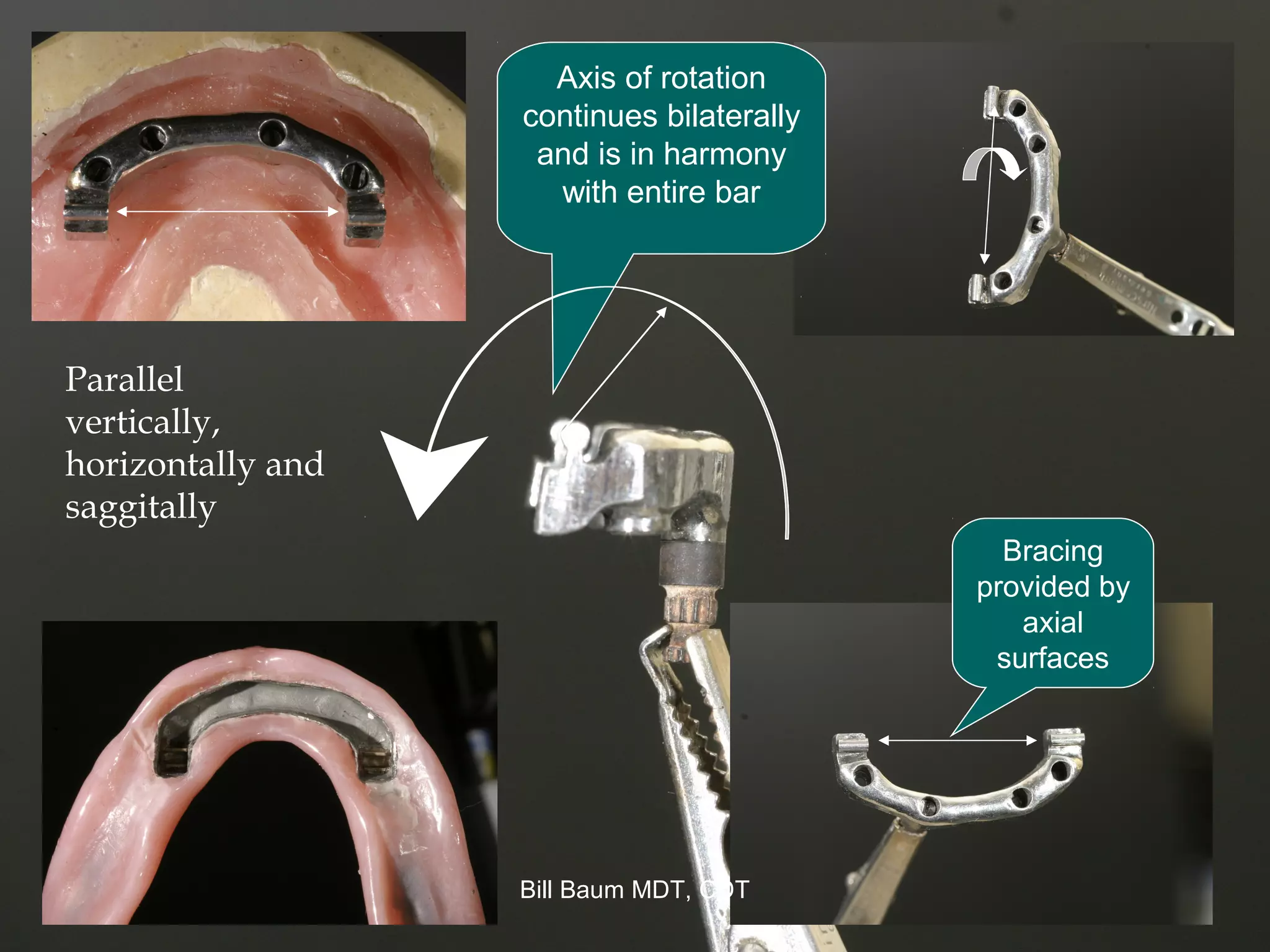 Removable Partial denture Retainer Systems | PPT