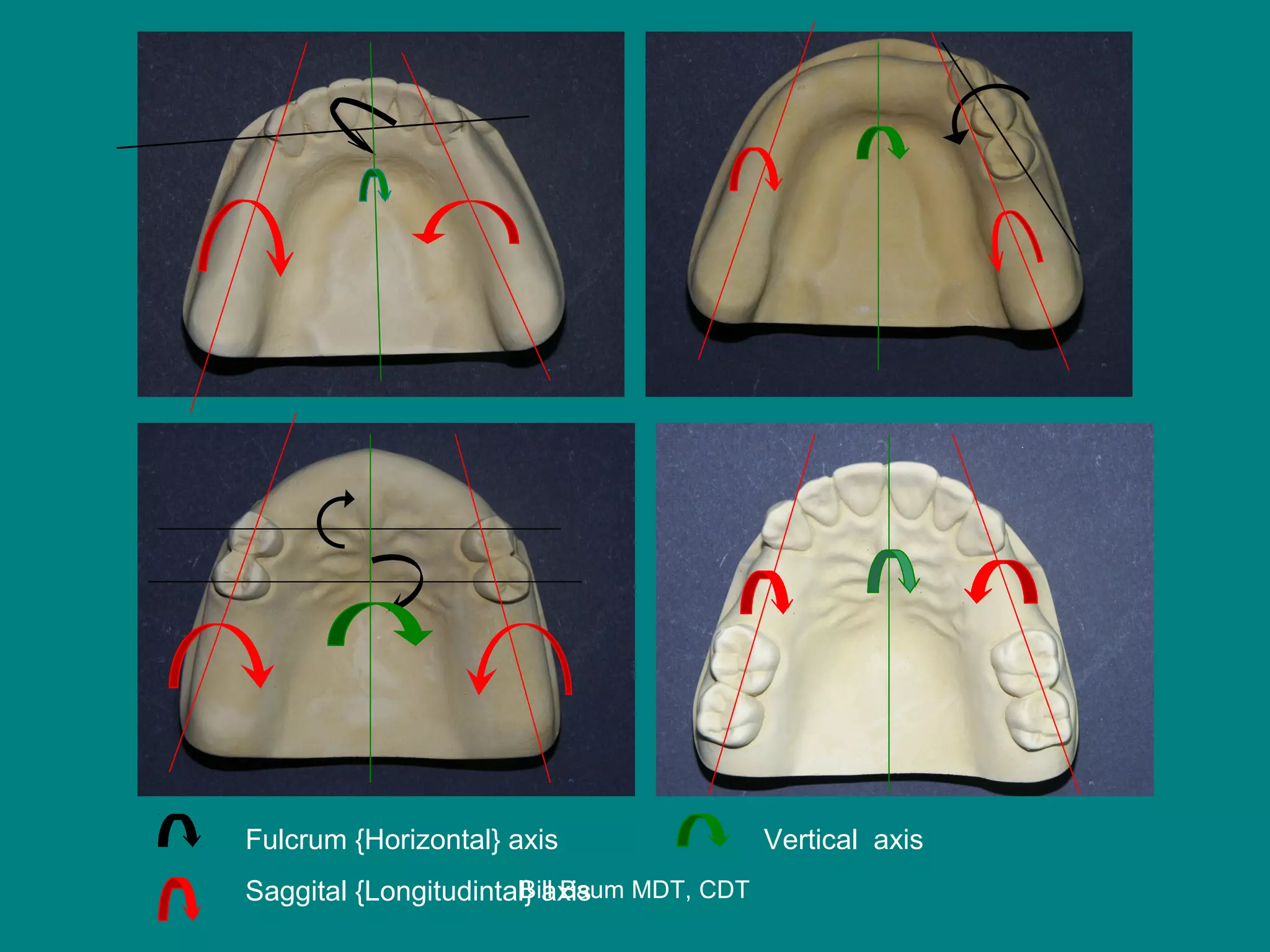 Removable Partial denture Retainer Systems | PPT