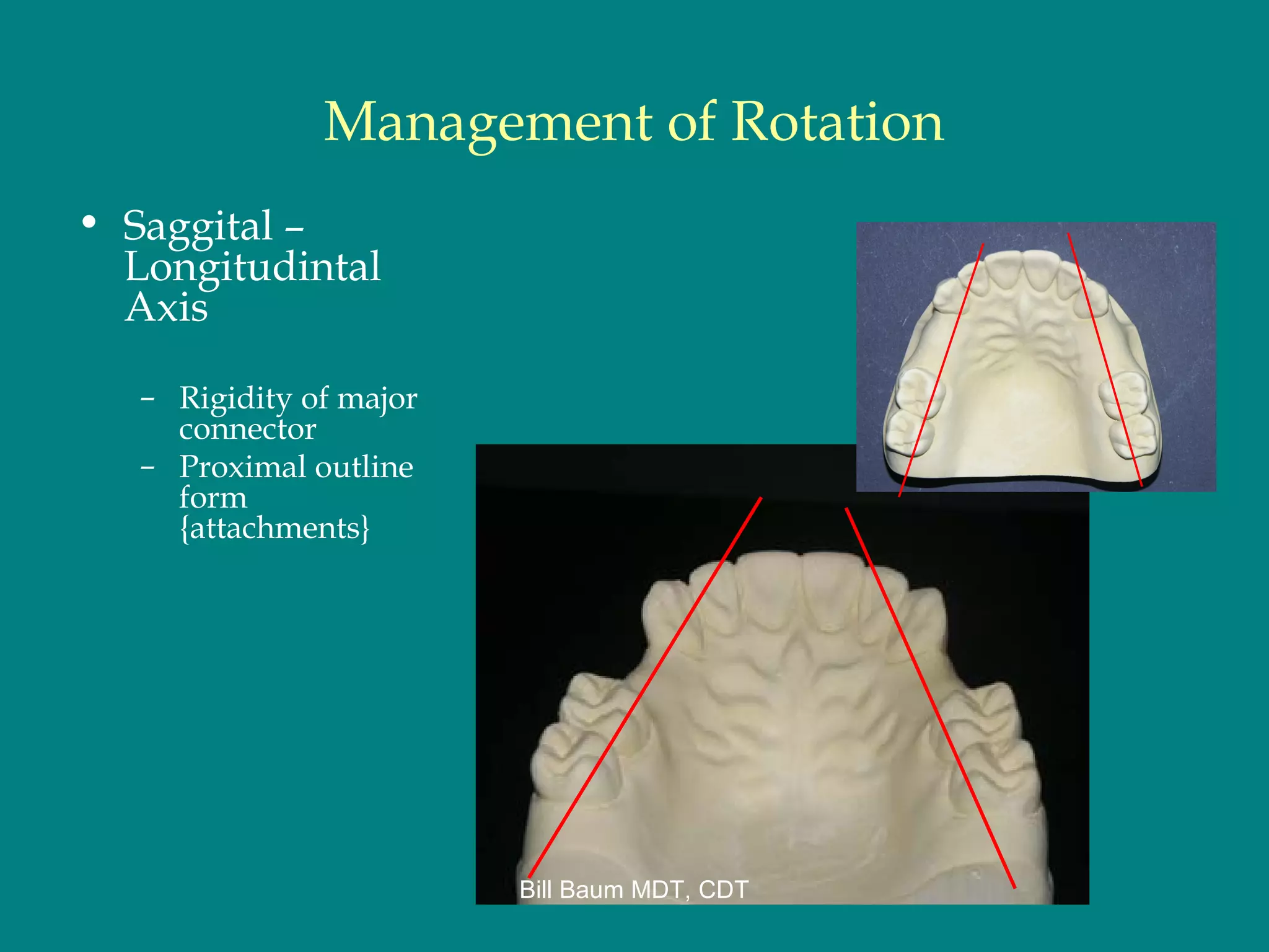 Removable Partial denture Retainer Systems | PPT