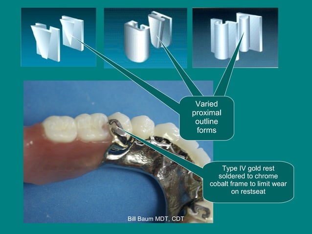 Removable Partial denture Retainer Systems | PPT | Dental Health ...