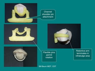 Removable Partial denture Retainer Systems | PPT