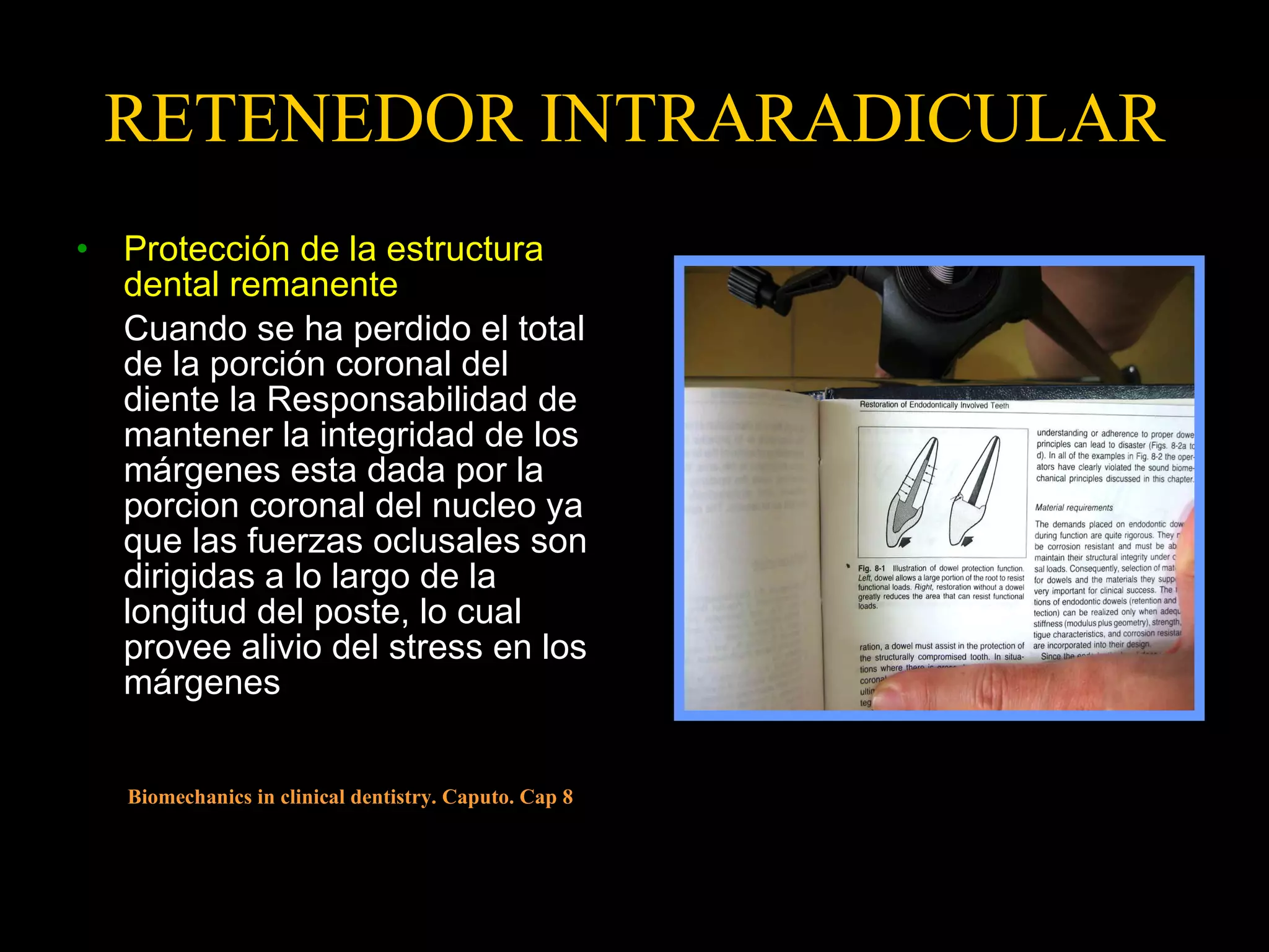 Retenedores Intraradiculares 2 | PPT