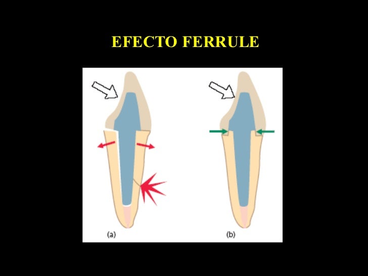 Retenedores Intraradiculares 2