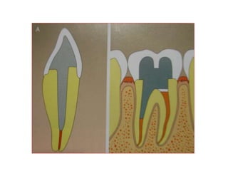 Retenedores intraradiculares en odontologia | PPTX