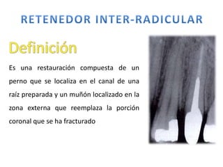 Retenedores intraradiculares en odontologia | PPTX