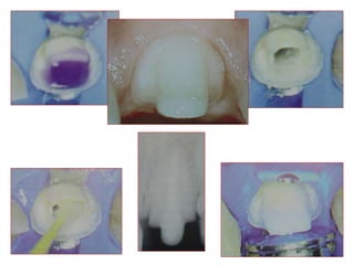 Retenedores intraradiculares en odontologia | PPTX