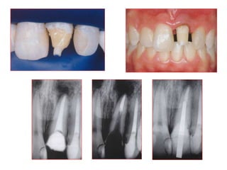 Retenedores intraradiculares en odontologia | PPTX