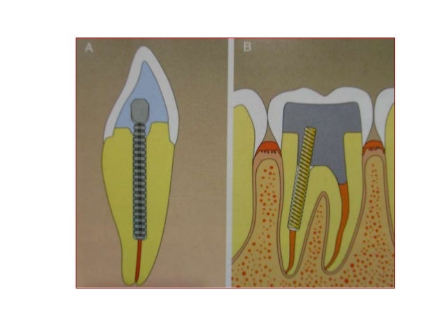 Retenedores intraradiculares en odontologia