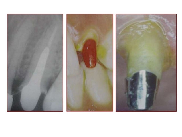 Retenedores intraradiculares en odontologia