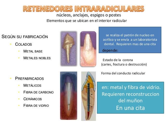 Retenedores intraradiculares en odontologia