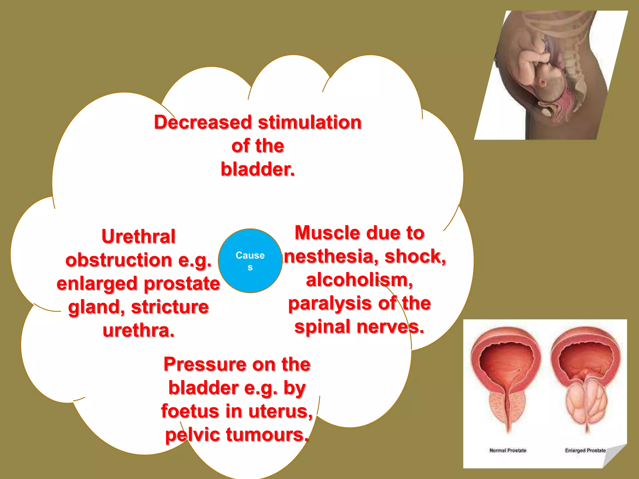 Retension & Incontinence of Urine.pptx