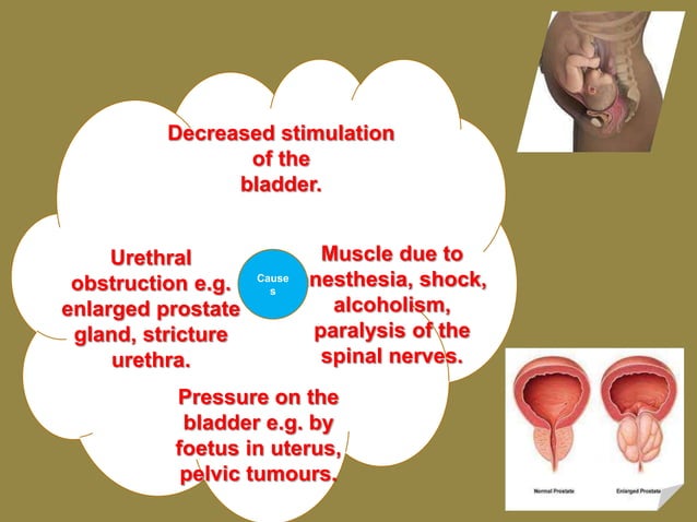 Retension & Incontinence of Urine.pptx | Sexual Conditions | Sexual Health