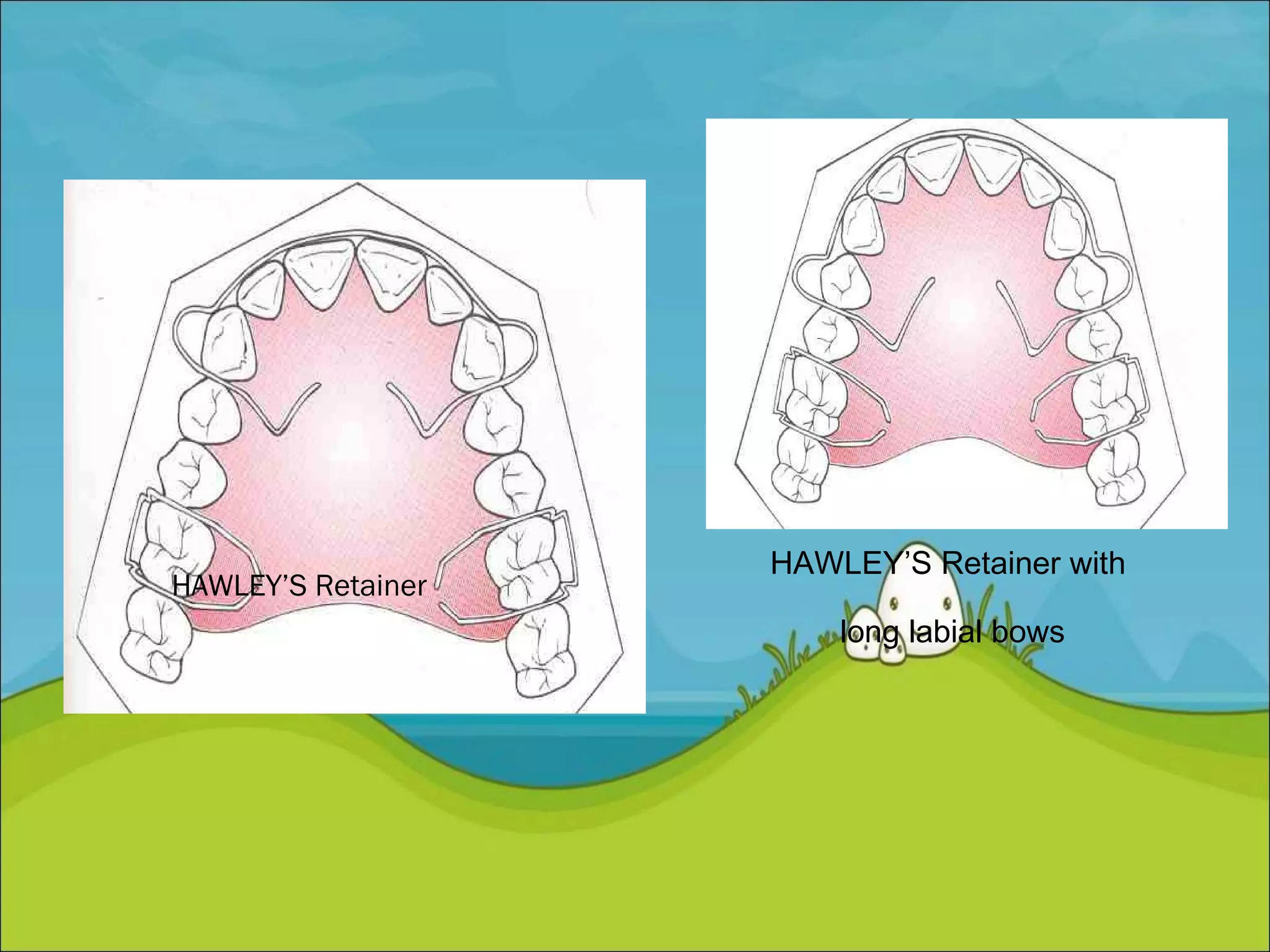 Retention and Relapse in orthodontics | PPT
