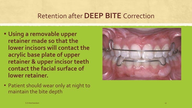 Retention in Orthodontics (Dentistry) | PDF