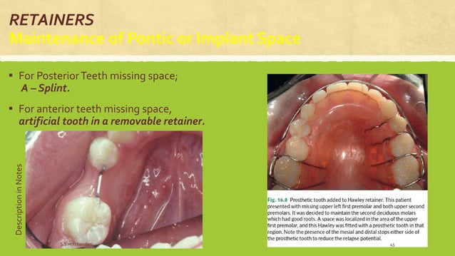 Retention in Orthodontics (Dentistry) | PDF