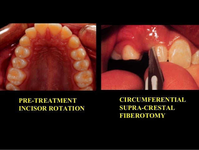 Retention1 /certified fixed orthodontic courses by Indian dental acad…