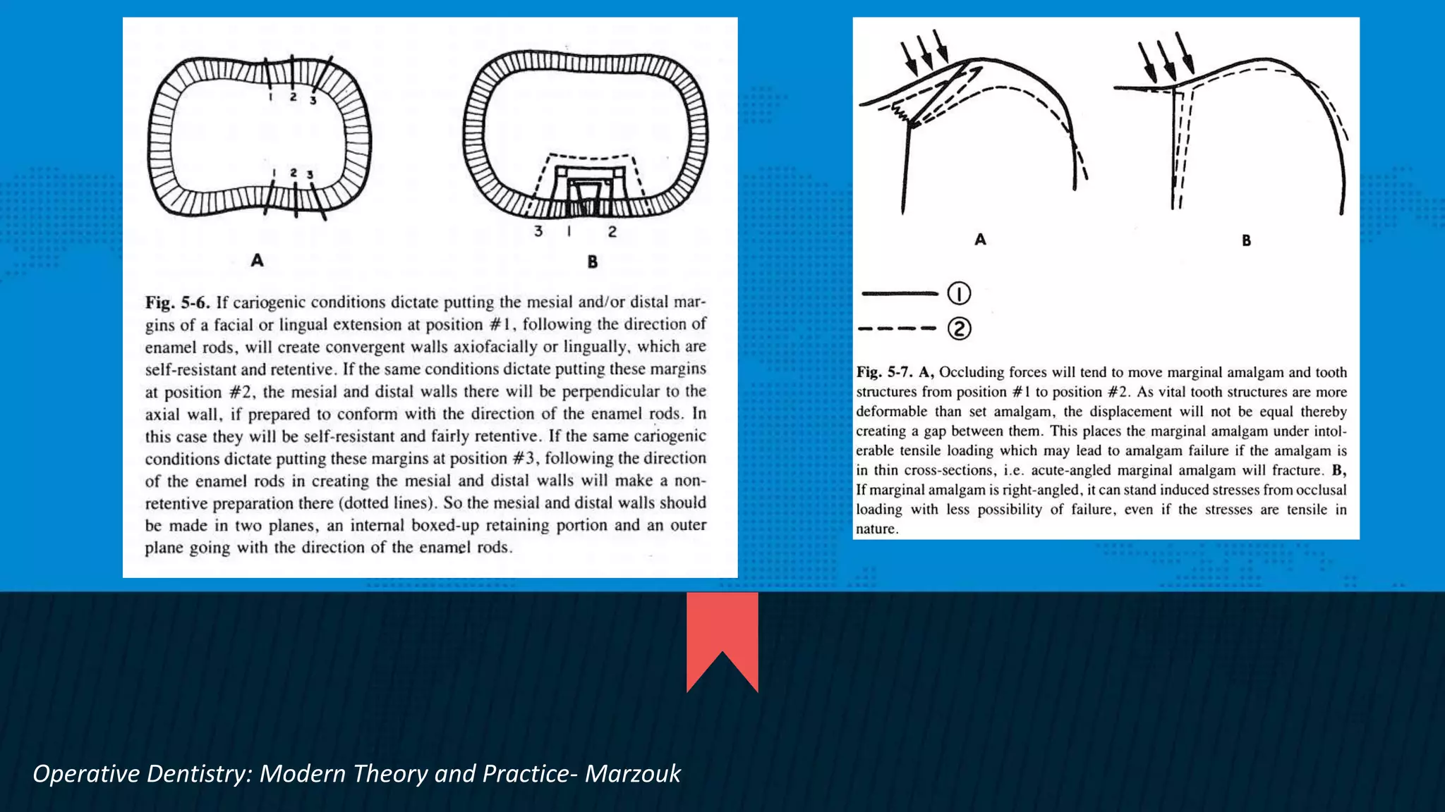 Retention and resistance forms of cavity design | PPTX | Dental Health ...