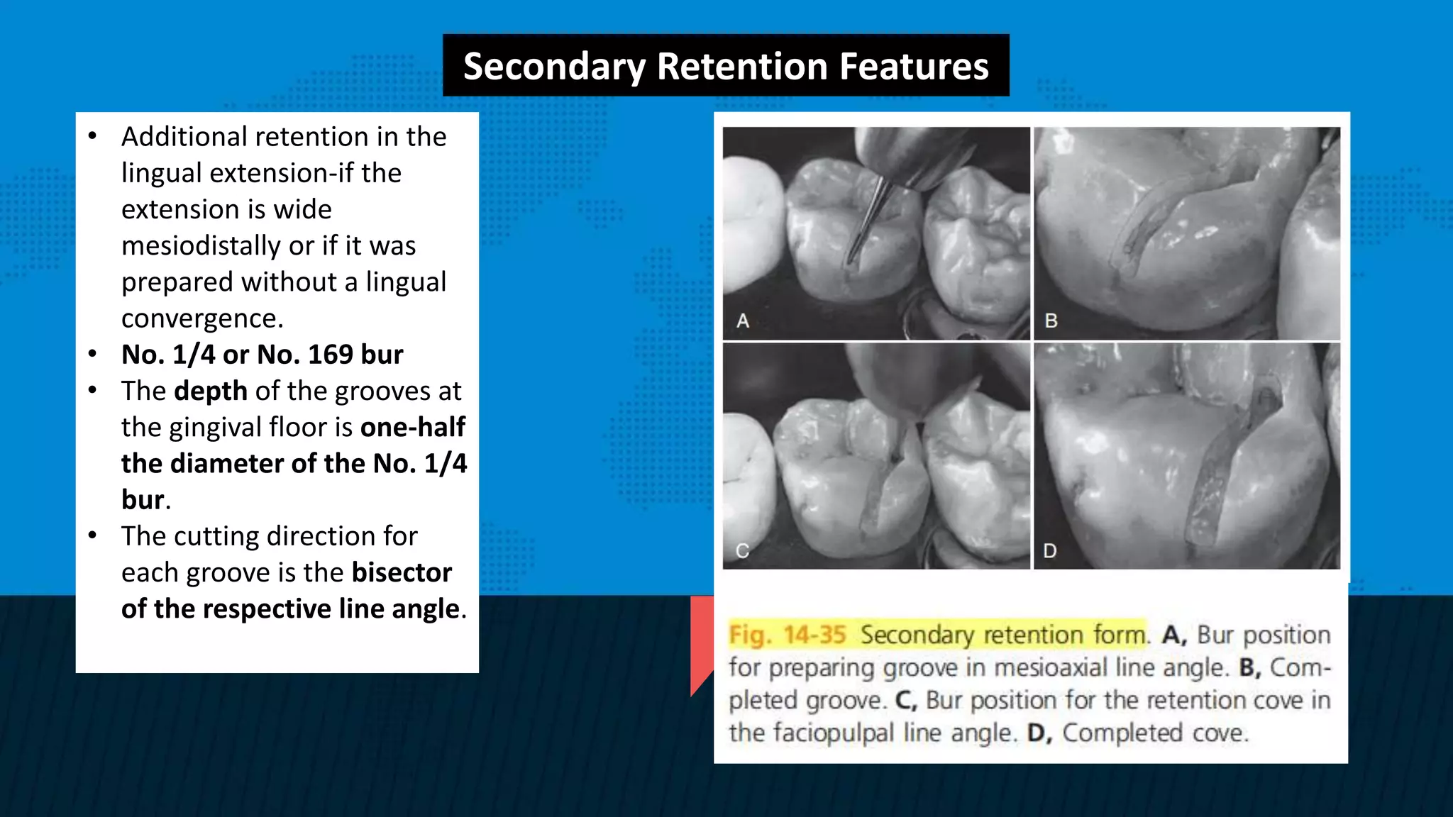 Retention and resistance forms of cavity design | PPTX | Dental Health ...