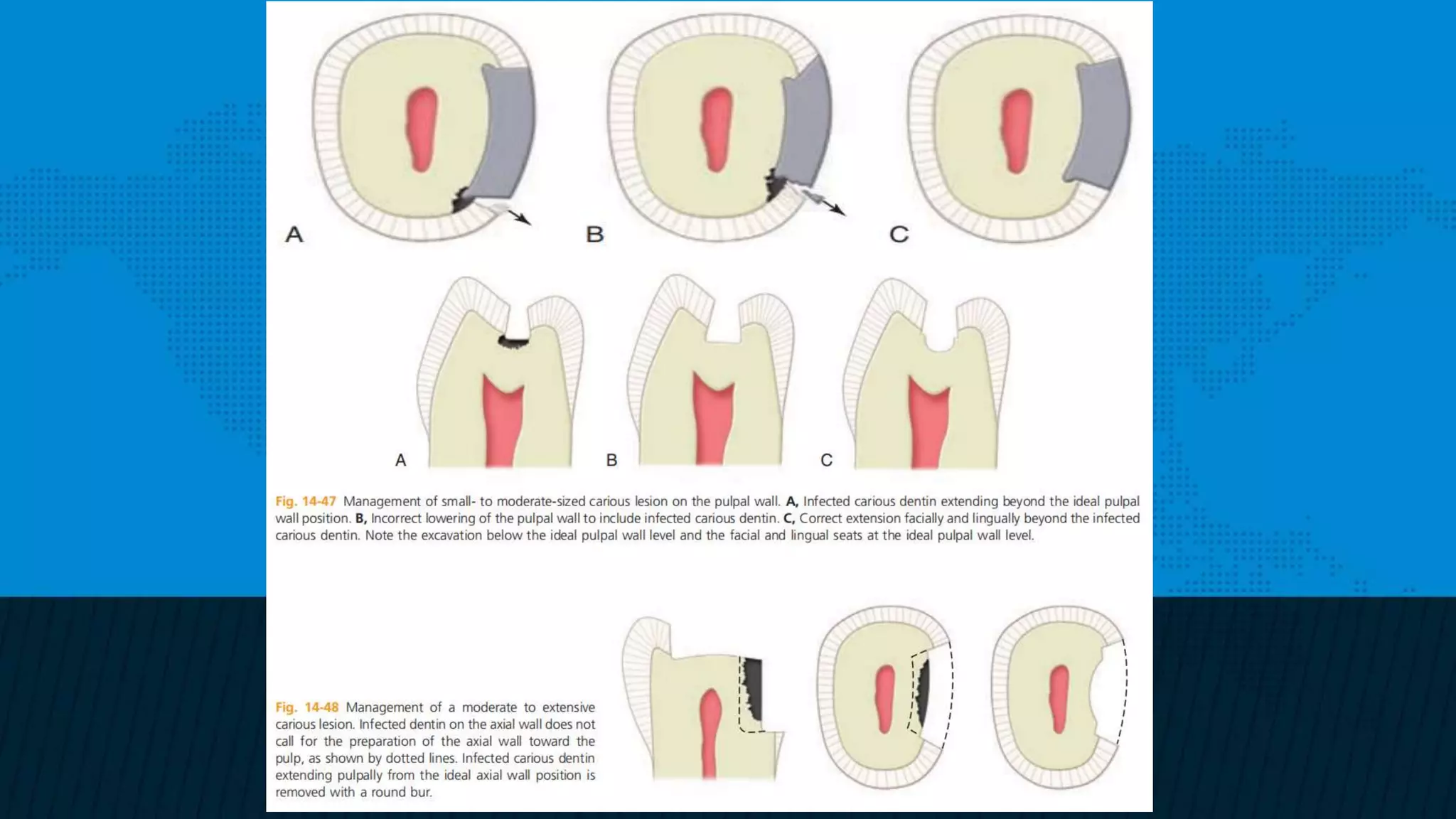 Retention and resistance forms of cavity design | PPTX