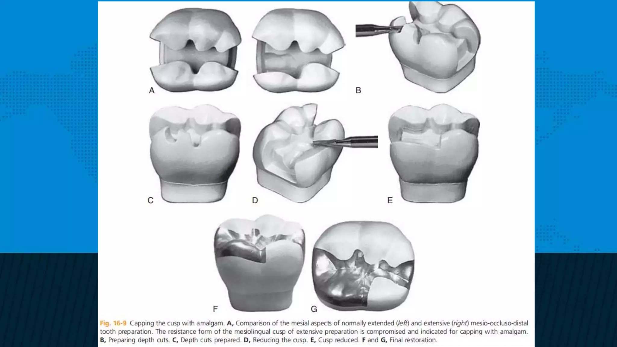 Retention and resistance forms of cavity design | PPTX
