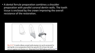 Retention and resistance forms of cavity design | PPTX